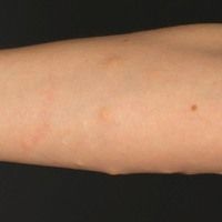 Ablagerungsdermatosen (Übersicht) Bilder - Altmeyers Enzyklopädie ...