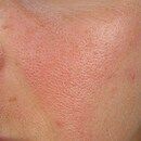 Rucinol - Altmeyers Encyclopedia - Department Dermatology