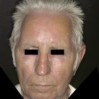 Argyria Images - Altmeyers Encyclopedia - Department Dermatology