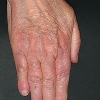 Acrodermatitis chronica atrophicans Images - Altmeyers Encyclopedia ...