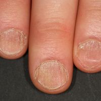 Alopecia areata (Übersicht) Images - Altmeyers Encyclopedia ...