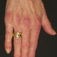 Dermatomyositis (overview) Images - Altmeyers Encyclopedia - Department ...