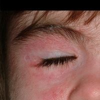 Dermatomyositis (overview) Images - Altmeyers Encyclopedia - Department ...