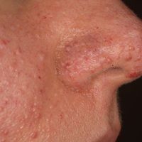 Adenoma sebaceum Bilder - Altmeyers Enzyklopädie - Fachbereich Dermatologie