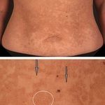 Pityriasis versicolor (overview) - Altmeyers Encyclopedia - Department ...