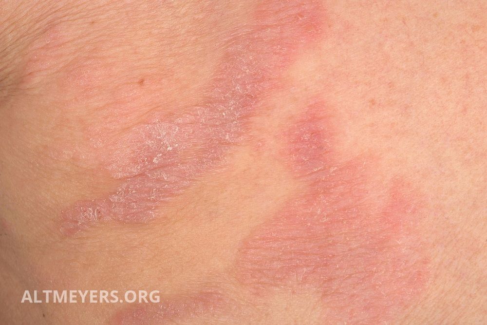 Parapsoriasis Treatment