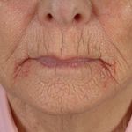 Actinic elastosis - Altmeyers Encyclopedia - Department Dermatology