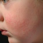 Gianotti-Crosti-Syndrom - Altmeyers Enzyklopädie - Fachbereich Dermatologie