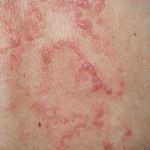 Linear iga dermatosis - Altmeyers Encyclopedia - Department Dermatology