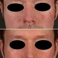 Rosacea papulopustulosa Images - Altmeyers Encyclopedia - Department ...