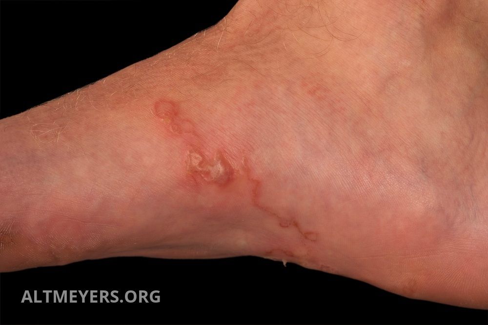 Visceral Larva Migrans