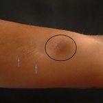 Lipoatrophy, localized after glucocorticosteroid injections - Altmeyers ...