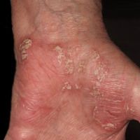 Psoriasis palmaris et plantaris (Plaquetyp) Images - Altmeyers ...