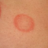 Erythema anulare centrifugum Bilder - Altmeyers Enzyklopädie ...