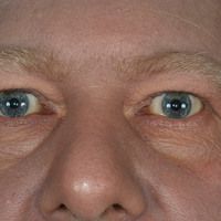 Melanoma cutaneous Images - Altmeyers Encyclopedia - Department Dermatology