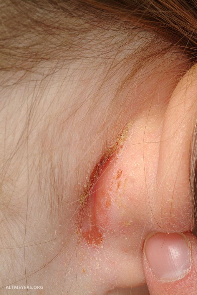 Weeping Behind The Ear