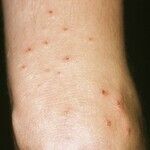 Prurigo form of atopic dermatitis - Altmeyers Encyclopedia - Department ...