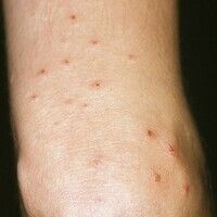 Prurigoform der atopischen Dermatitis Bilder - Altmeyers Enzyklopädie ...