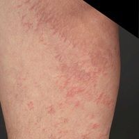 Asteatotic dermatitis Images - Altmeyers Encyclopedia - Department ...