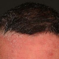 Psoriasis capitis Bilder - Altmeyers Enzyklopädie - Fachbereich ...