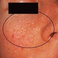 Milia en plaque Images - Altmeyers Encyclopedia - Department Dermatology