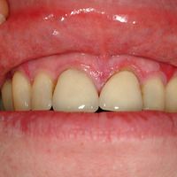 Images for Oral mucosa, Skin defects (superficially, deep) - Altmeyers ...