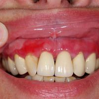 Lichen planus mucosae Bilder - Altmeyers Enzyklopädie - Fachbereich ...