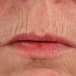 Perlèche (overview) - Altmeyers Encyclopedia - Department Dermatology