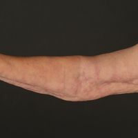 Livedo reticularis Images - Altmeyers Encyclopedia - Department Dermatology