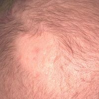 Naevus sebaceus (Kindesalter) Images - Altmeyers Encyclopedia ...