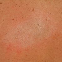 Atrophie der Haut (Übersicht) Bilder - Altmeyers Enzyklopädie ...
