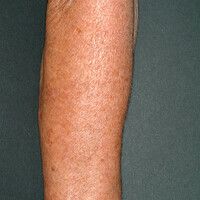Lichtalterung Images - Altmeyers Encyclopedia - Department Dermatology