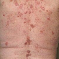 Pemphigus erythematosus Images - Altmeyers Encyclopedia - Department ...