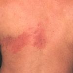 Zoster - Altmeyers Enzyklopädie - Fachbereich Dermatologie