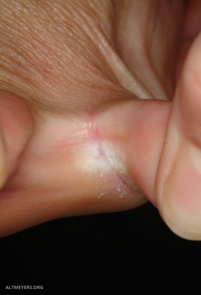 Interdigital Tinea Pedis