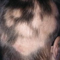 Alopecia (overview) Images - Altmeyers Encyclopedia - Department ...