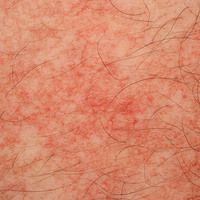 Teleangiectasia macularis eruptiva perstans Images - Altmeyers ...