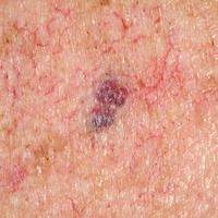 Teleangiectasia Images - Altmeyers Encyclopedia - Department Dermatology