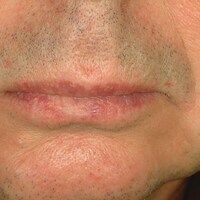 Talgdrüsen ektope Bilder - Altmeyers Enzyklopädie - Fachbereich ...