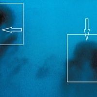 Scleroderma systemic Images - Altmeyers Encyclopedia - Department ...