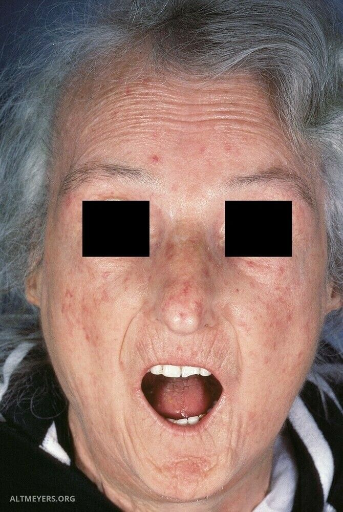 Systemic Scleroderma Face