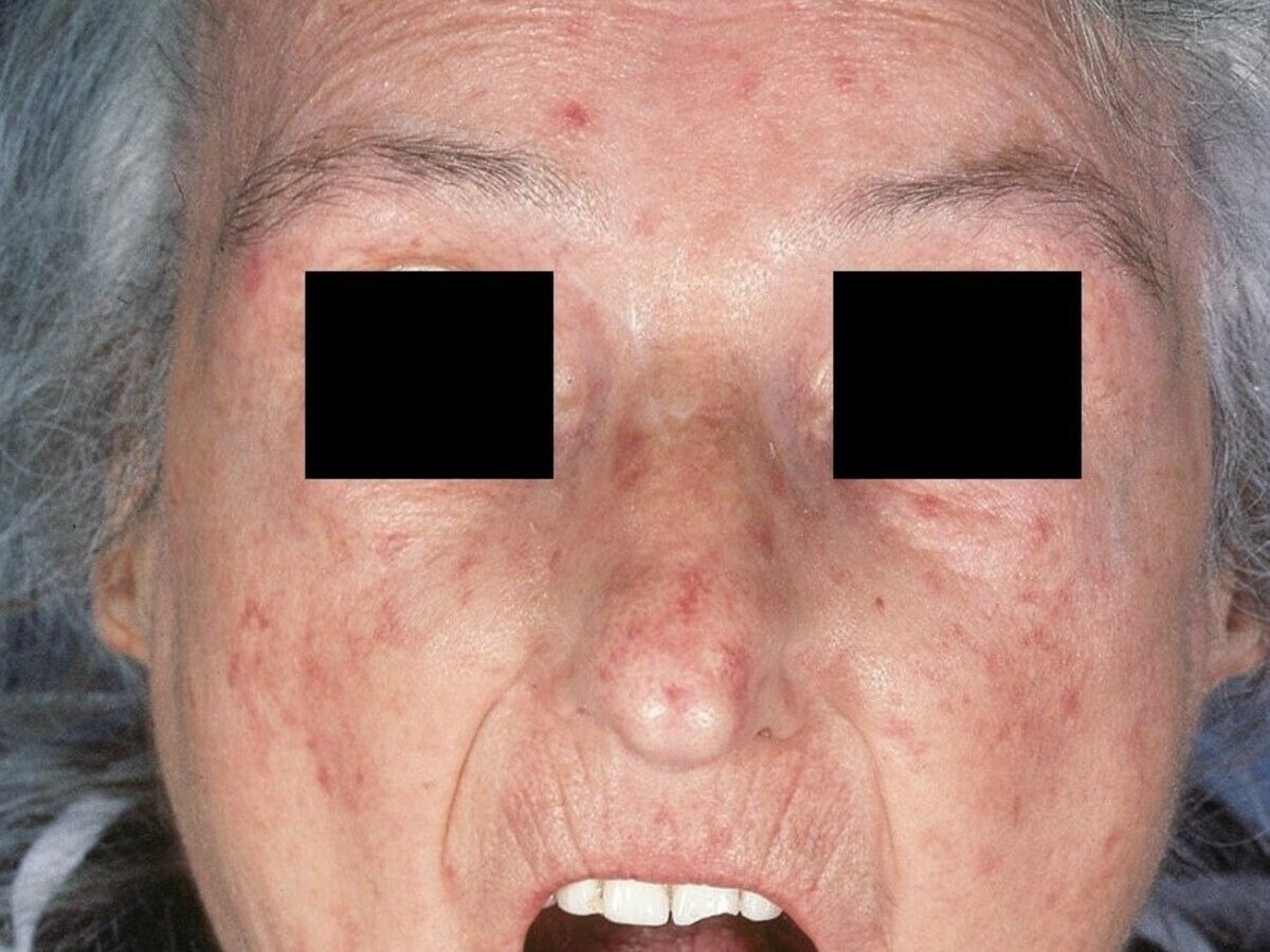 Systemic Scleroderma Face