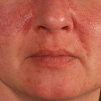 Mixed connective tissue disease Images - Altmeyers Encyclopedia ...