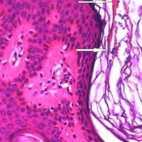 Pityriasis versicolor alba Images - Altmeyers Encyclopedia - Department ...