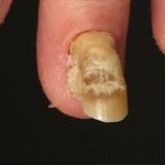 Retronychie - Altmeyers Enzyklopädie - Fachbereich Dermatologie