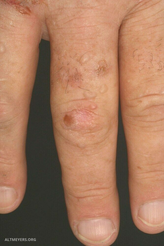 Porphyria Cutanea Tarda Urine