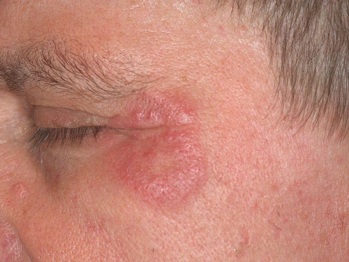 Lymphadenosis Benigna Cutis