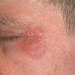 Pseudolymphomas of the skin (overview) - Altmeyers Encyclopedia ...