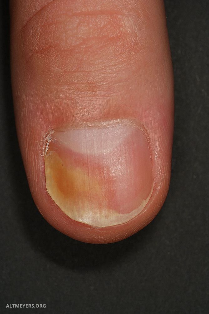Psoriasis Nails Oil Spot