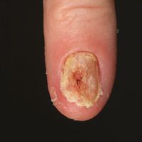 Psoriasis of the nails Bilder - Altmeyers Enzyklopädie - Fachbereich ...